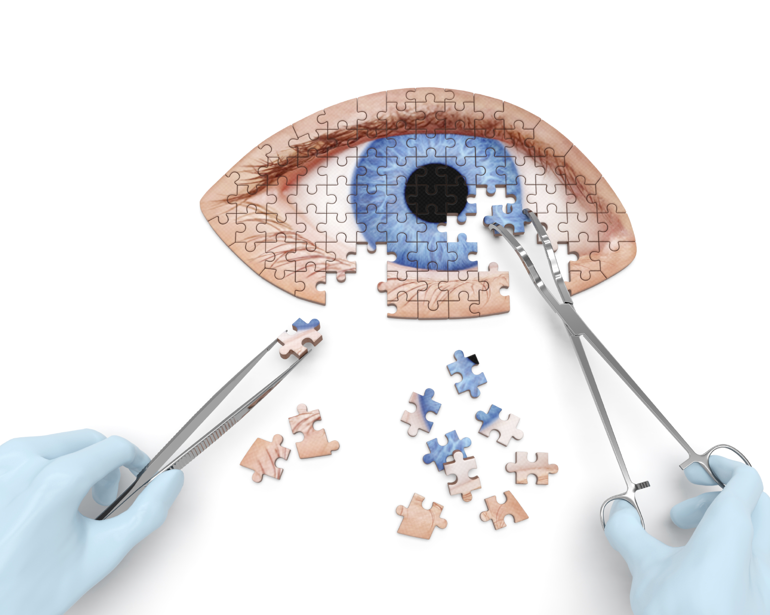 Options For Cataracts Besides Surgery Laguna Hills Home Care